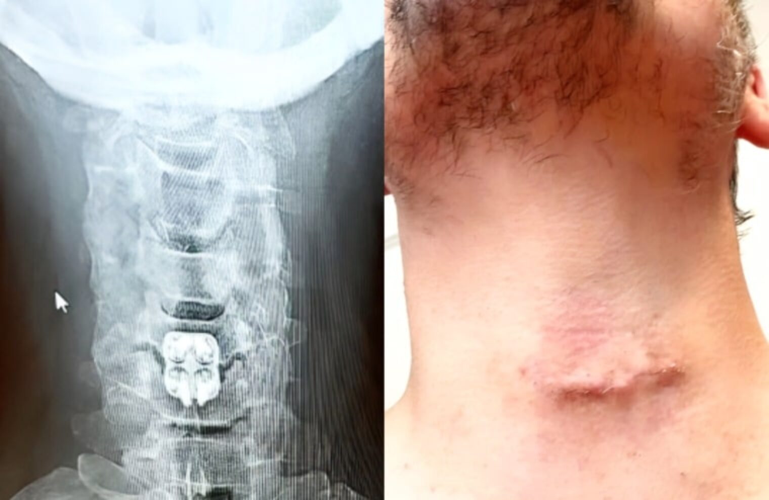AEW Original Reveals He’s Undergone Neck Surgery – WEB IS JERICHO
